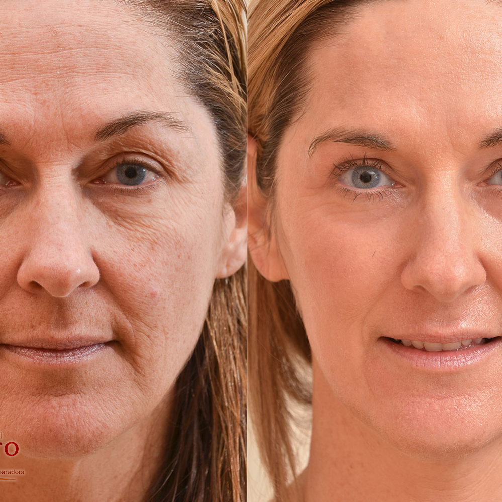Resurfacing - CLINICA DR. MANUEL HERRERO